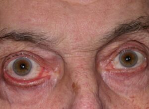 Photos of Ectropion Surgery - Senile/Involutional | Eyelid Plastic Surgery