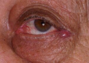 Photos of Ectropion Surgery - Senile/Involutional | Eyelid Plastic Surgery